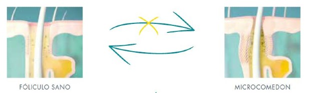Prevención del acné, atacar los comedones "invisibles", clave